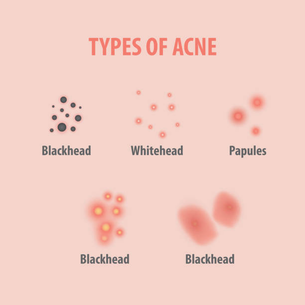 what-s-acne-and-how-it-happens